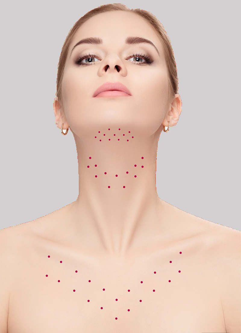 Harmonização de papada, pescoço e colo sem cortes com microagulhamento ...