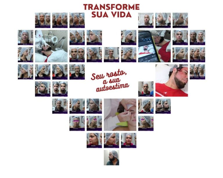 O guia completo dos cuidados pós microagulhamento em Brasília para uma ...