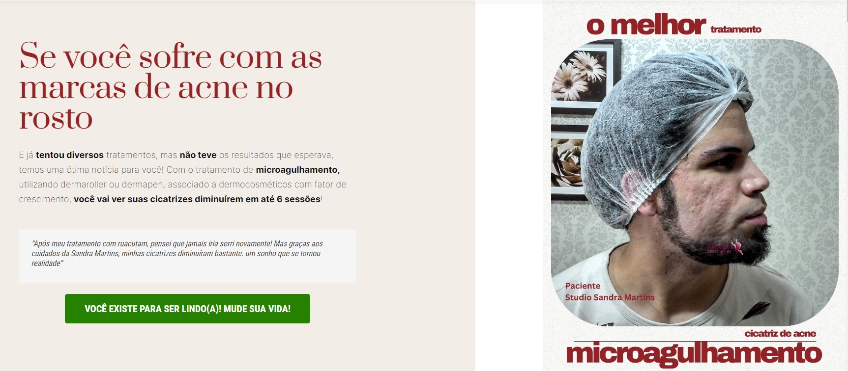 Como o microagulhamento diminui as cicatrizes de acne - Sandra Martins ...