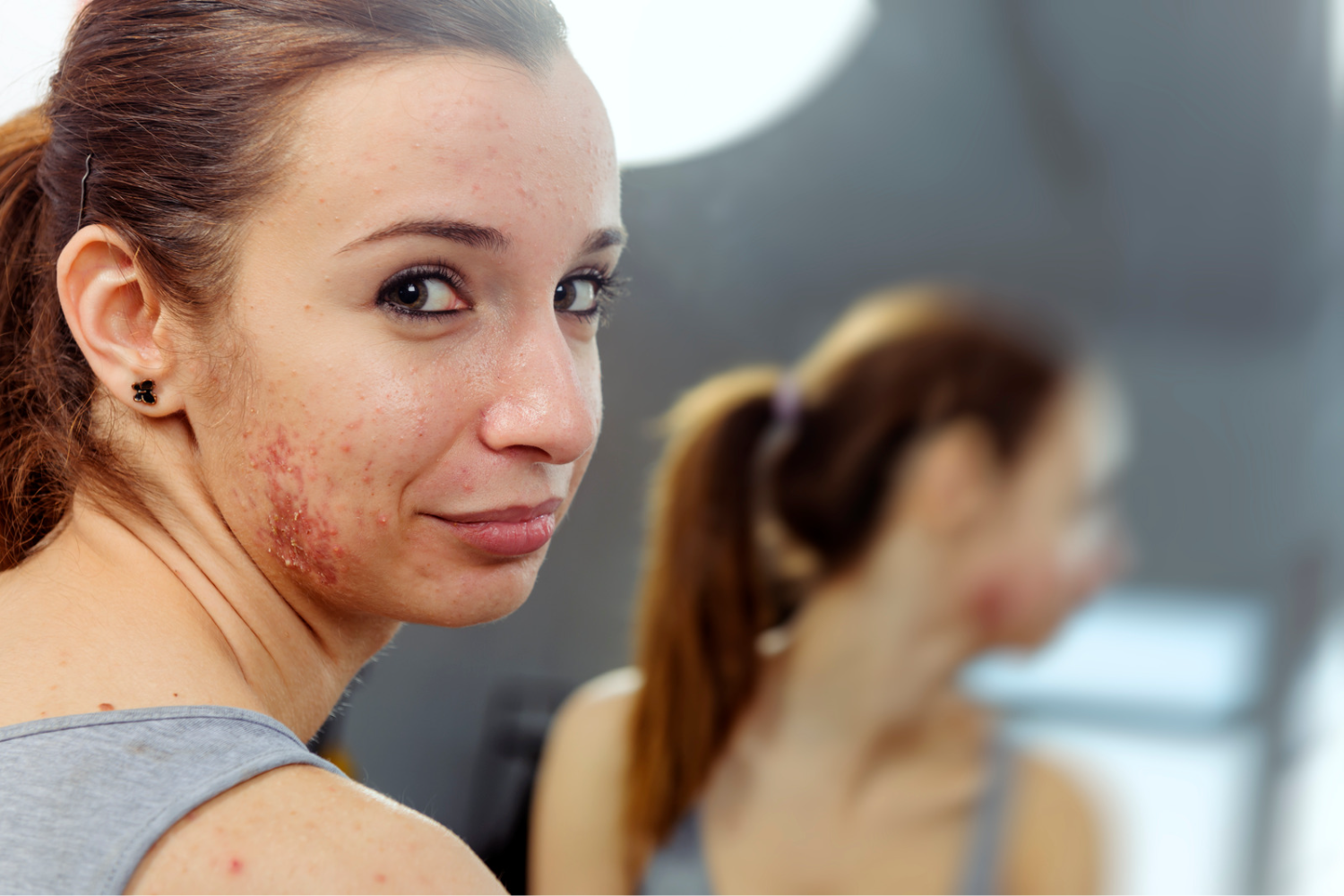 mulher-academia-acne-espinha - Studio Sandra Martins Estética Facial