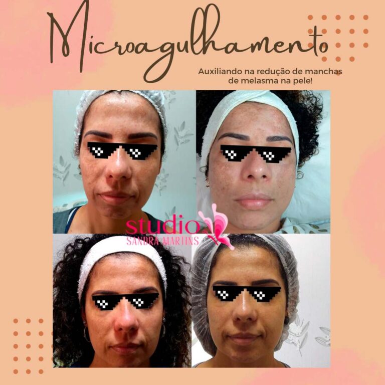 O guia completo dos cuidados pós microagulhamento em Brasília para uma ...