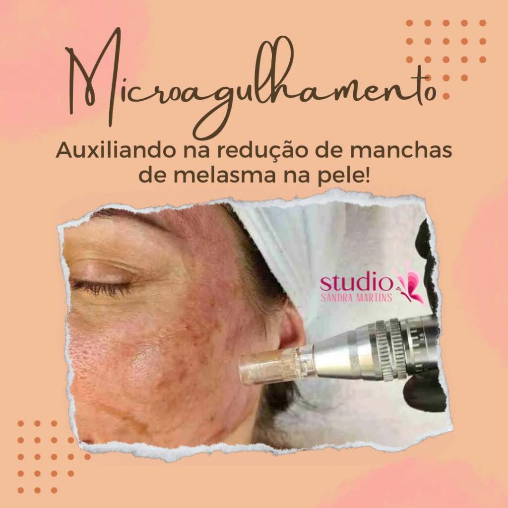 O guia completo dos cuidados pós microagulhamento em Brasília para uma ...