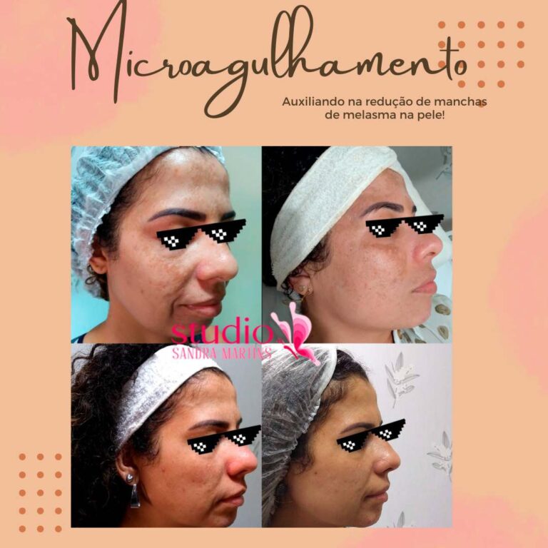 O guia completo dos cuidados pós microagulhamento em Brasília para uma ...