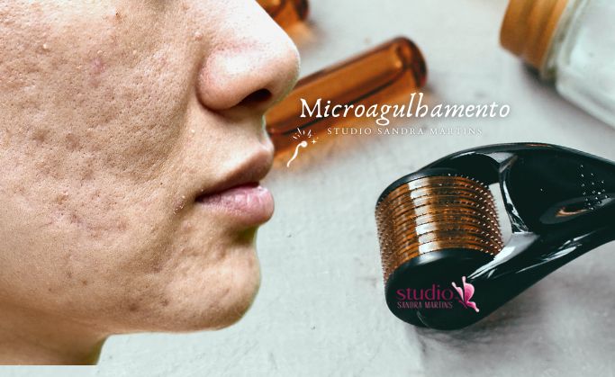 Taguatinga, Cicatriz de Acne, Autoestima e Microagulhamento - Sandra ...