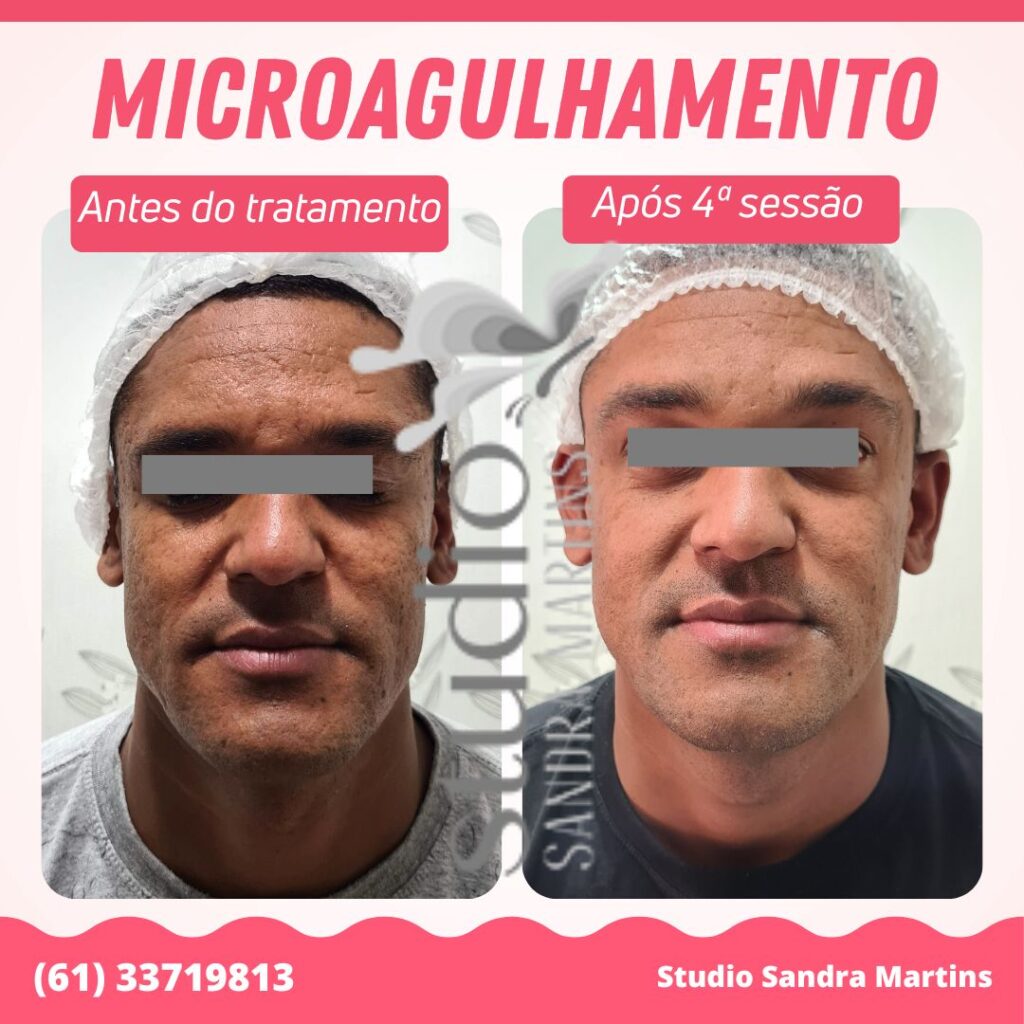 Microagulhamento o melhor tratamento para cicatrizes de acne em ...