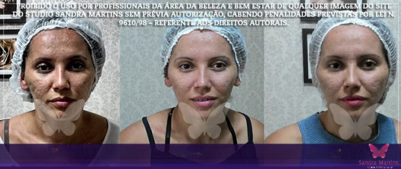 Microagulhamento para Preenchimento de Cicatrizes Acne Brasília ...