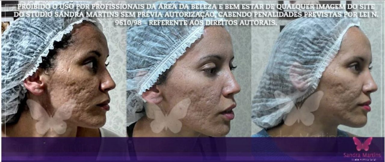 Microagulhamento para Preenchimento de Cicatrizes Acne Brasília ...